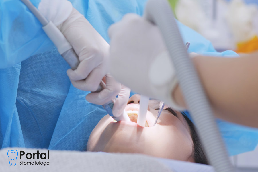 Skaling zębów - Portal Stomatologa