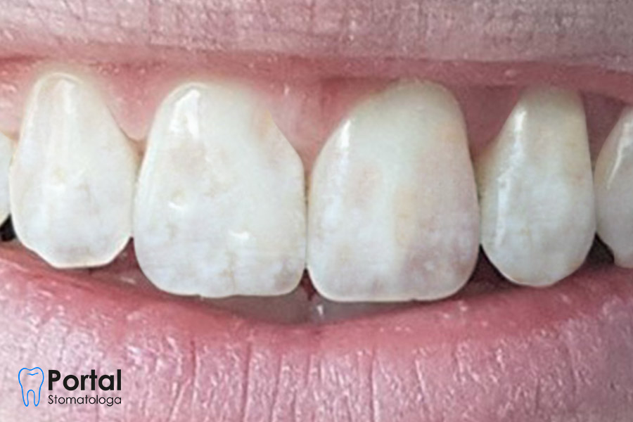 Fluoroza - Portal Stomatologa