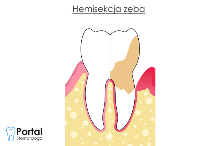 Hemisekcja zęba - Portal Stomatologa