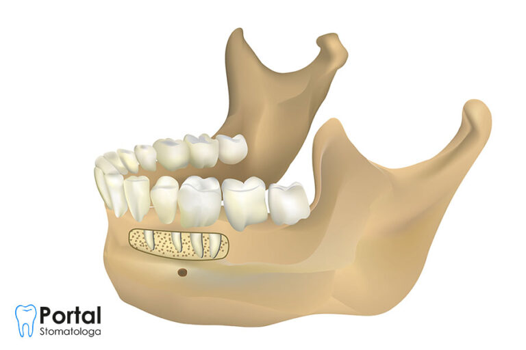 Torbiel samotna kości - Portal Stomatologa