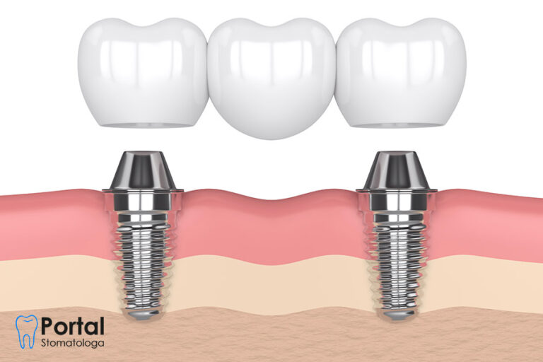 Mostek zębowy - Portal Stomatologa