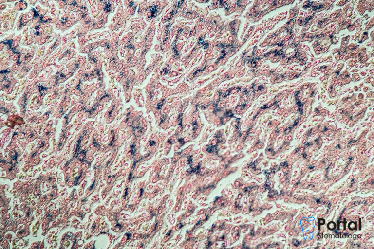 Zespół Goldenhara - Portal Stomatologa