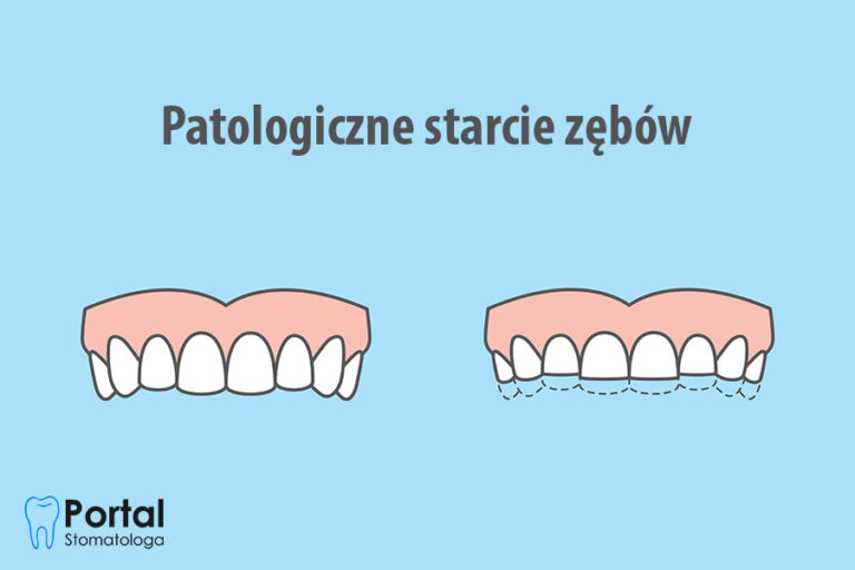Patologiczne starcie zębów - Portal Stomatologa