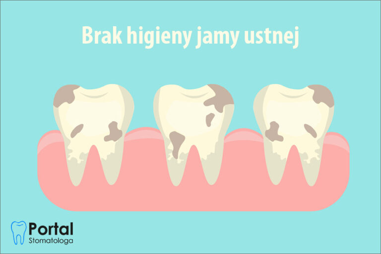 Brak higieny jamy ustnej - Portal Stomatologa